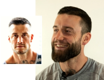 Jhaki: Fotografias Antes e depois - 4200 Enxertos | Elithair